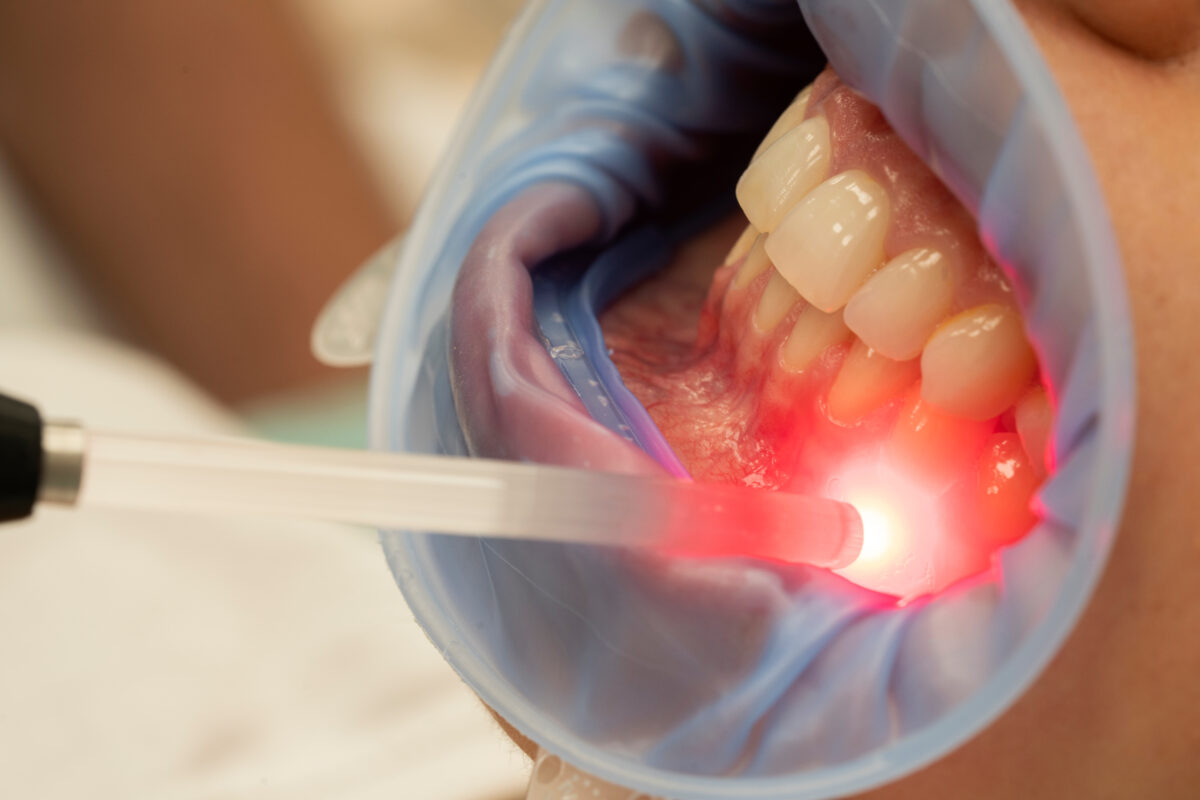 Laser Treatment for Gum Disease in Independence, Ohio
