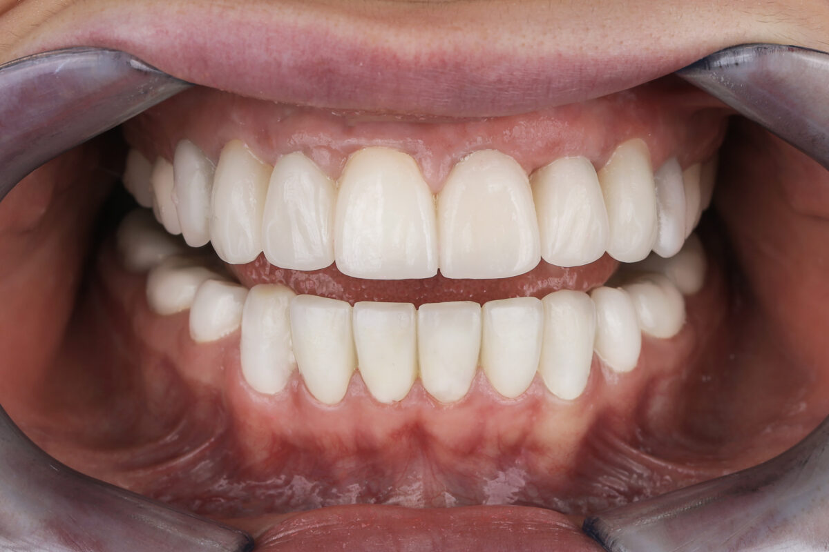 How to Reverse Gum Recession?