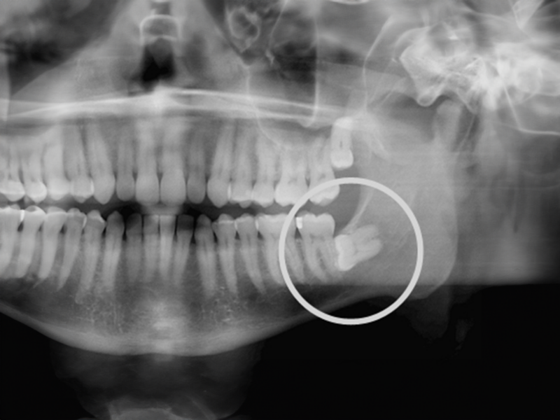 Wisdom Teeth - Bilski Dental
